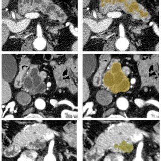 Examples Of Different IPMN On Axial Contrast Enhanced CT Scans In The