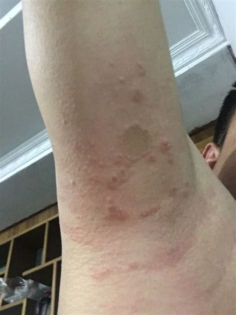 腋下红斑图片腋下花斑癣的图片3 伤感说说吧