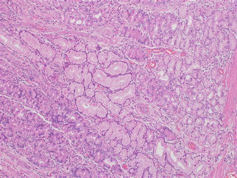 High Power View Shows Gastric Glands Lined By Parietal Cells And Others