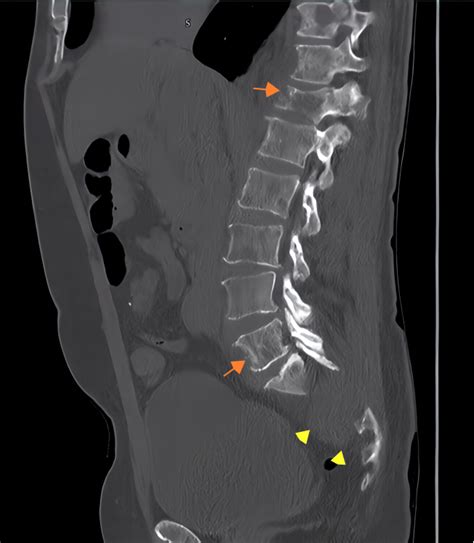 Unusual Case Of Plasma Cell Neoplasm Masquerading As A Sacral Mass In A