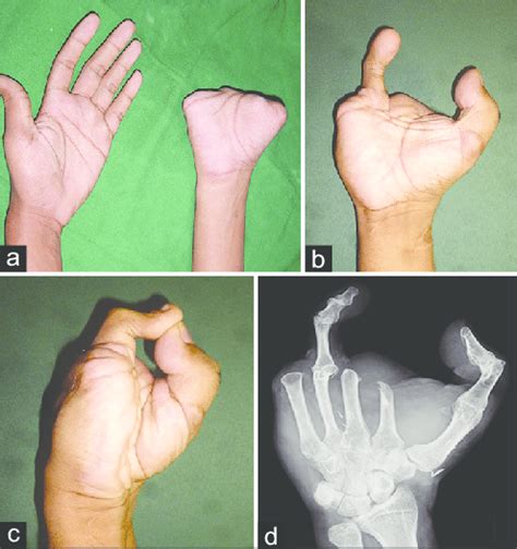 Patient 5 Type 2a Metacarpal Hand A Both Hands Prior To Toe