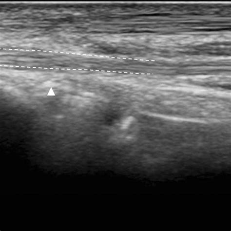 The Gap Between The Volar Prominence Of The Volar Locking Plate And The