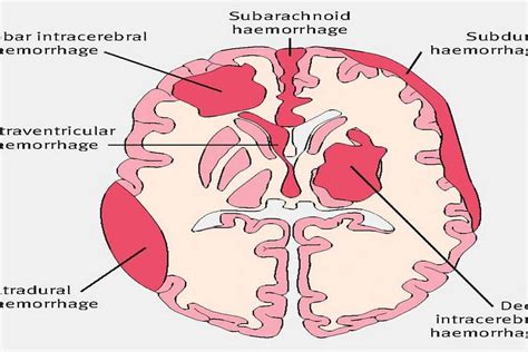 10 Details That You Must Know About Intracranial Hemorrhage Louie
