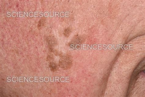Pigmented Seborrhoeic Warts Stock Image Science Source Images
