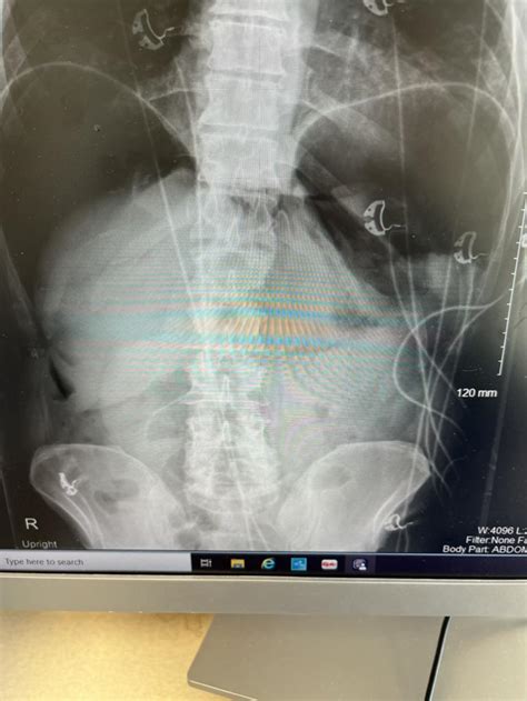 Patient Went In For A Colonoscopy Rradiology