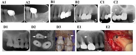 Figure 1 From Vertical Root Fracture In Non Endodontically And