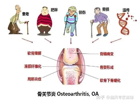 6种常见的关节炎，你知道多少？ 知乎