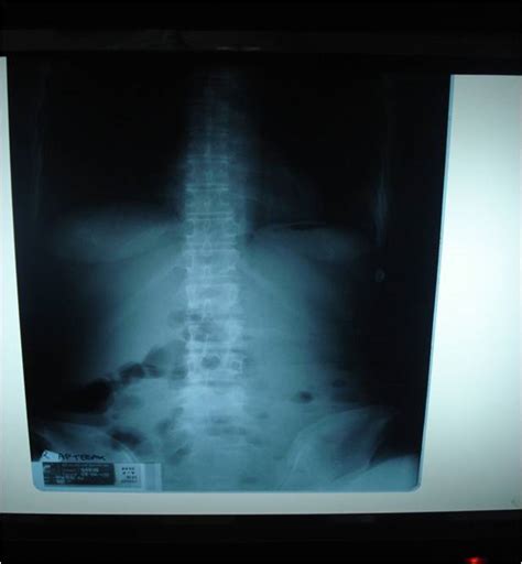 Proyeksi Pemeriksaan Abdomen 3 Posisi Aditya Radiografer