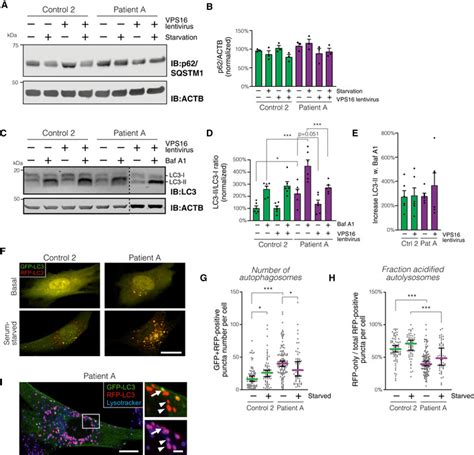 Bi‐allelic Vps16 Variants Limit Hops Corvet Levels And Cause A Mucopolysaccharidosis‐like