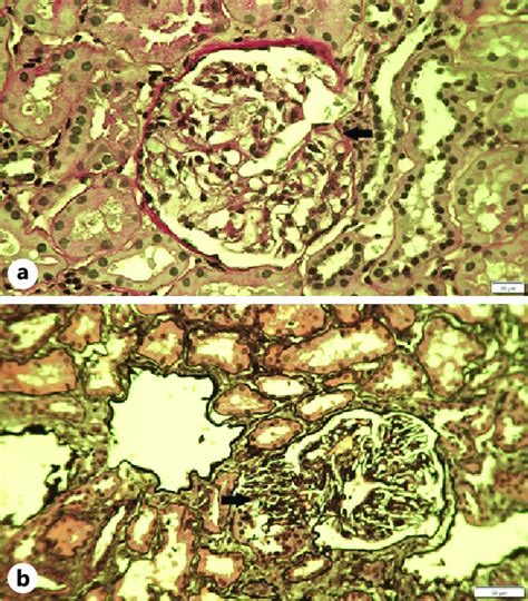 Tip Lesion Variant Of FSGS In A Patient With COVID A Focal Adhesion Download Scientific