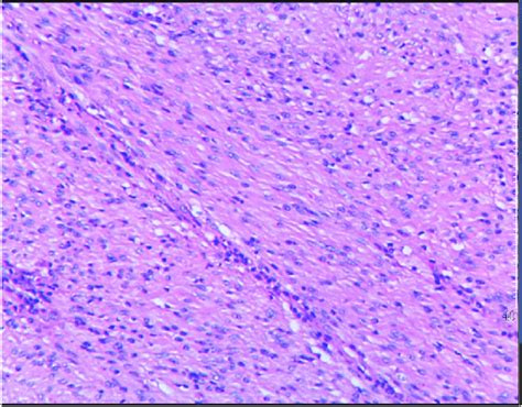 The Photomicrograph Of Lesion Included Spindle Shaped Cells Download Scientific Diagram