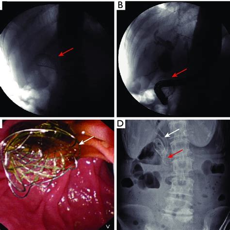 Biliary Metal Stent Placement Process Of The Patient A X Ray Showed Download Scientific