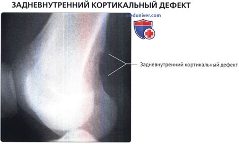 Рентгенограмма КТ МРТ задневнутреннего кортикального дефекта