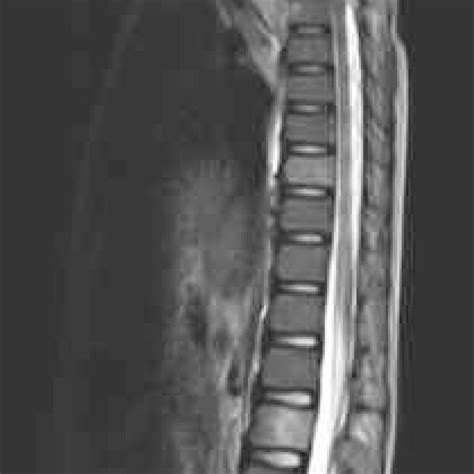Magnetic Resonance Imaging Showing Spinal Abscesses And Spinal Cord Download Scientific Diagram