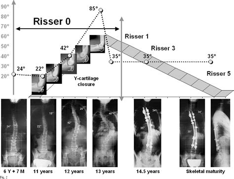 Bone Age Greater Than Chronological Age Pikolsk