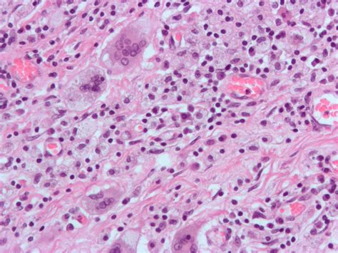 Chronic Inflammation Granulomas Lymphocytes Teachmesurgery