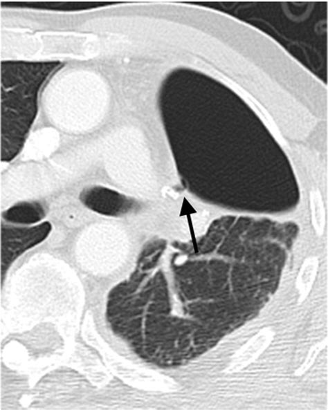 Postoperative Complications After Thoracic Surgery For Lung Cancer