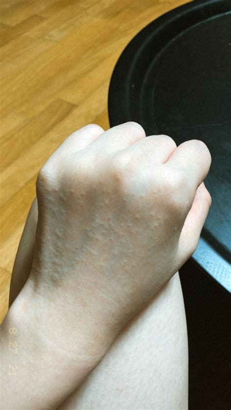 두드러기 고양이 알레르기 지식in