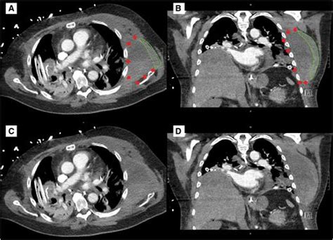 Chest Wall Hematoma After Continuous Serratus Anterior Plane Block
