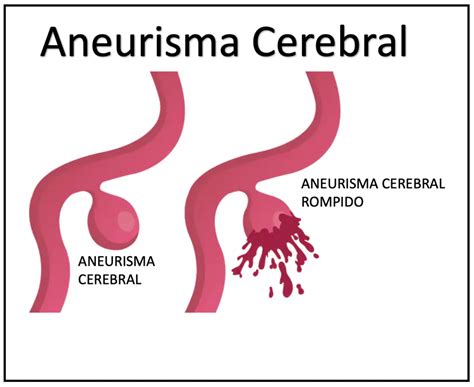 Aneurisma Cerebral Medicina De Excelência