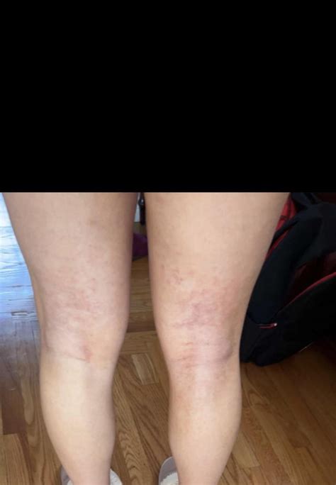Red Itchy Bumps On Side And Back Of Legs Rdermatologyquestions