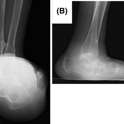 Preoperative Radiographs Of Case 1 Left Ankle Anteroposterior A