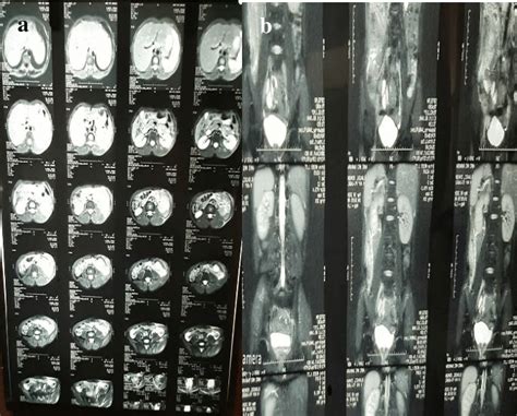 A And B Mdct Scan Of Whole Abdomen An Irregular Thick Rim Enhancing