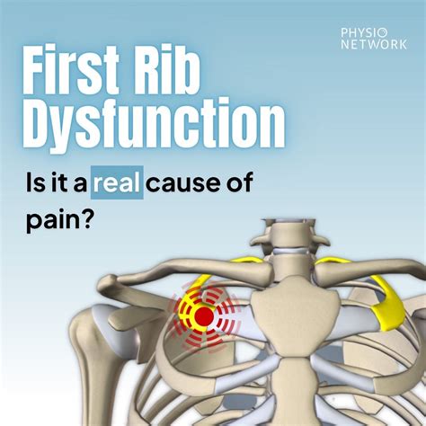 Physio Network On Linkedin 🤨 First Rib Dysfunction ⁠ ⁠ 👆🏻 Ever