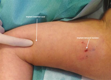 Subdermal Implant Birth Control