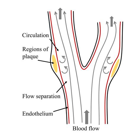 Schematic Of The Formation Of The Atherosclerosis Download