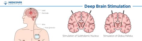 Deep Brain Stimulation Preparation Procedure And Recovery
