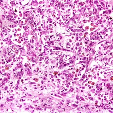 Angiosarcoma Basicmedical Key