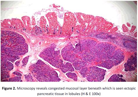 Heterotopic Pancreas Presenting With Intussusception A Rare Case