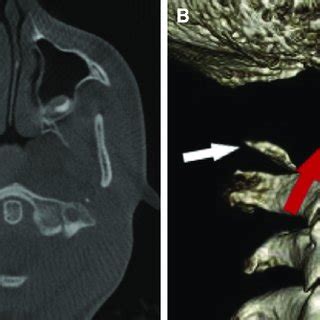 Patient 7 With Type D Defect A CBCT Axial Section Showing Absence Of