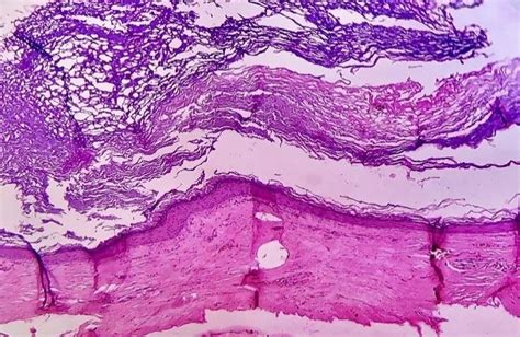 A Shows The Epithelial Lining With Abundant Keratin And The Minimal