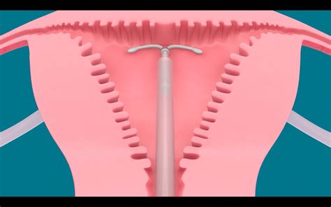 Iud Kyleena