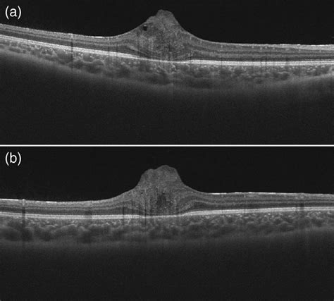 Ss Oct Imaging Depicting Tuberous Sclerosis Associated Retinal