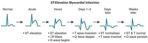 St Elevation Progression Myocardial Infarction Rn Nurse Ekg