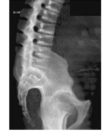 Sagittal Reformatted Lumbo Sacral Spine Ct Scan Confirmed The