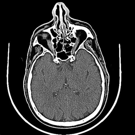 Skull Ct Scan Skull Head And Neck Cts