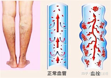 一只脚莫名其妙的肿胀不能大意了 知乎