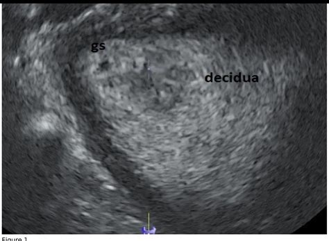 Figure 1 From Diagnosis Of Angular Pregnancy With 3d Ultrasound