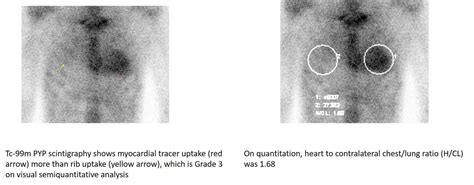 Evaluation Of Transthyretin Cardiac Amyloidosis With Technetium 99m