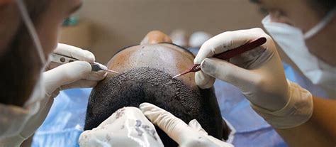 The Difference Between Hair Transplant And Scalp Micropigmentation