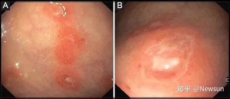 淋病的临床表现（附图片） 知乎