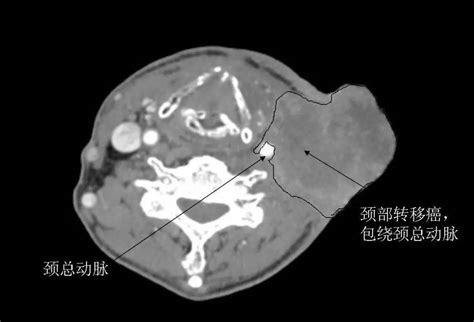 喉癌晚期患者颈部复发溃烂于振坤专家团队巧用胸部肌肉皮肤成功挽救患者生命 搜狐大视野 搜狐新闻
