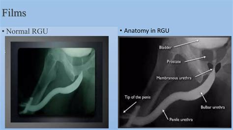 Radiological Procedure Of Retrograde Urethrography Rgu And Micturating Pptx