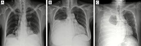 Grade Of Pleural Effusion A Mild Pleural Effusion B Moderate Download Scientific Diagram