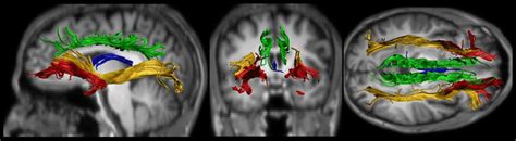 Fiber Tractography Of The Studied Tracts In A Control Subject In
