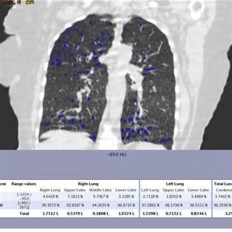 The Medical Research Councilamerican Thoracic Society Dyspnea Grading